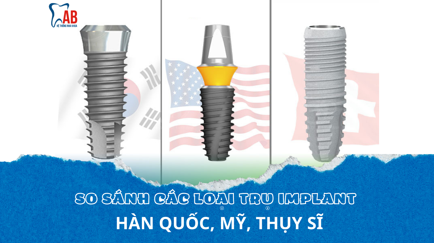 So sánh 3 loại trụ Implant phổ biến hiện nay trong cấy ghép Implant ...