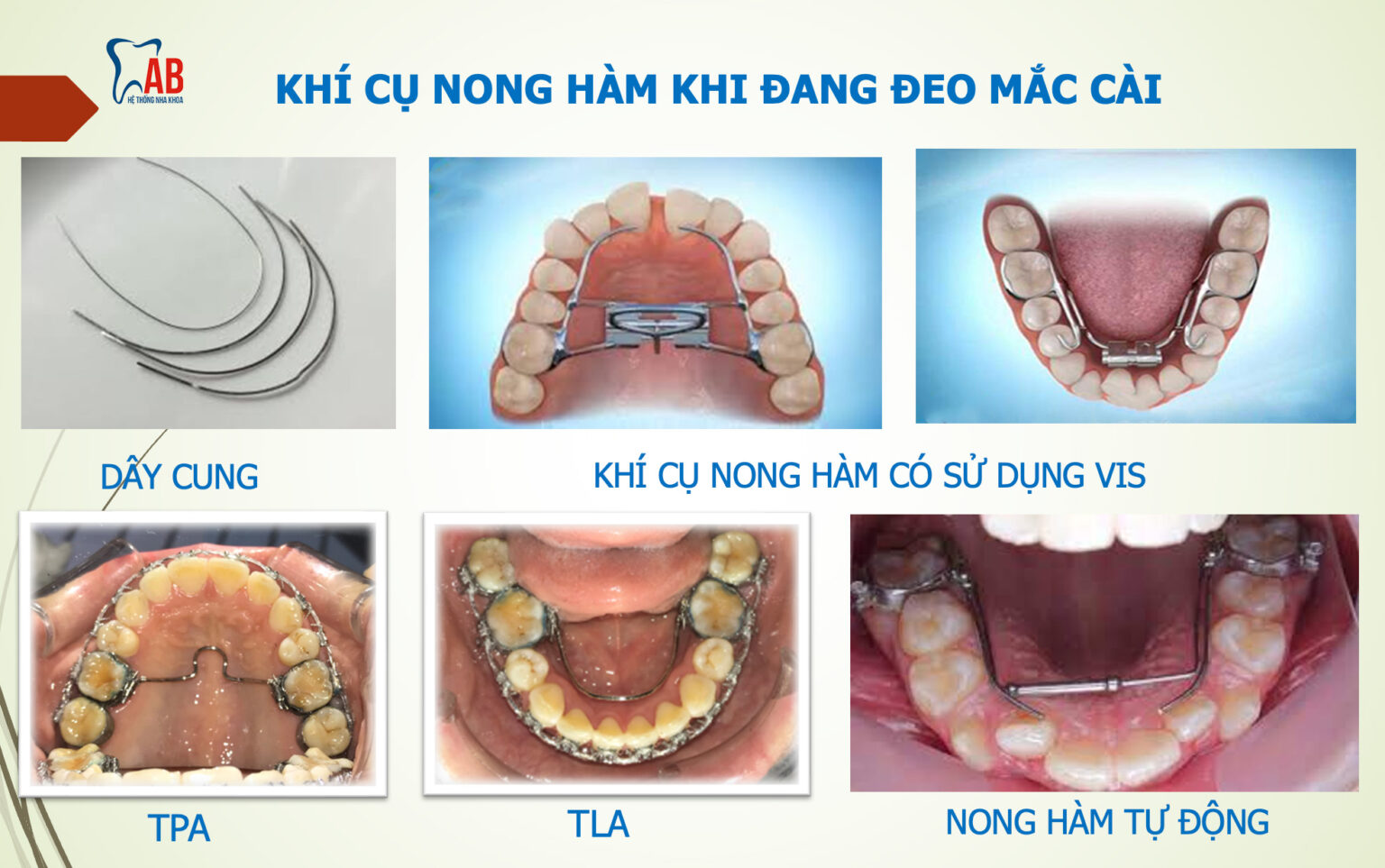 Tìm Hiểu Về Kỹ Thuật Nong Hàm Trong Chỉnh Nha Tại Hệ Thống Nha Khoa AB ...